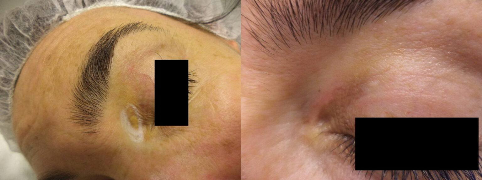 Moles, lumps and bumps | Platinum Dermatology